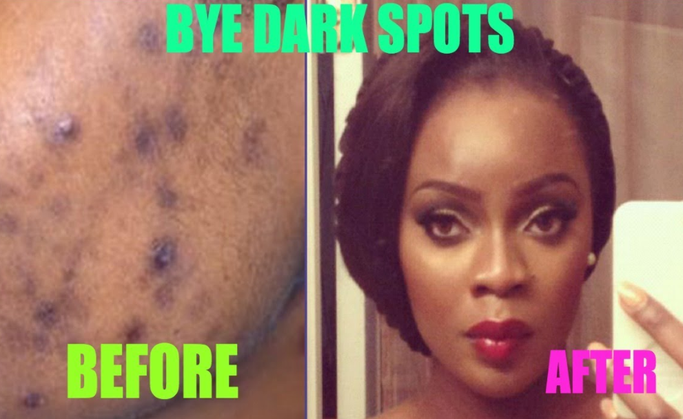 DIFFERENT TYPES OF ACNE - ALL ABOUT ACNE