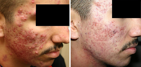 DIFFERENT TYPES OF ACNE - ALL ABOUT ACNE