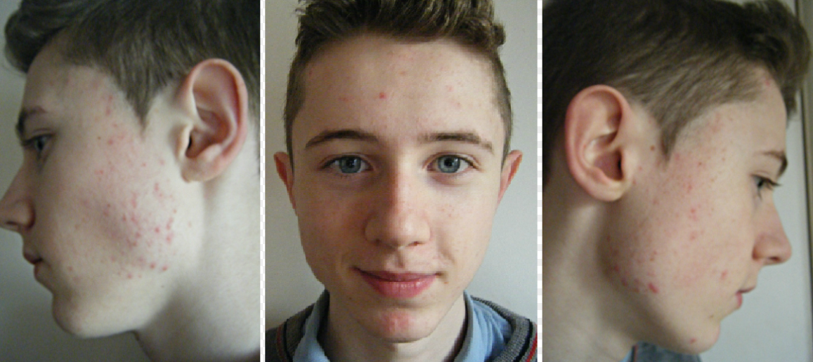 HOW TO USE PROACTIVE - ALL ABOUT ACNE